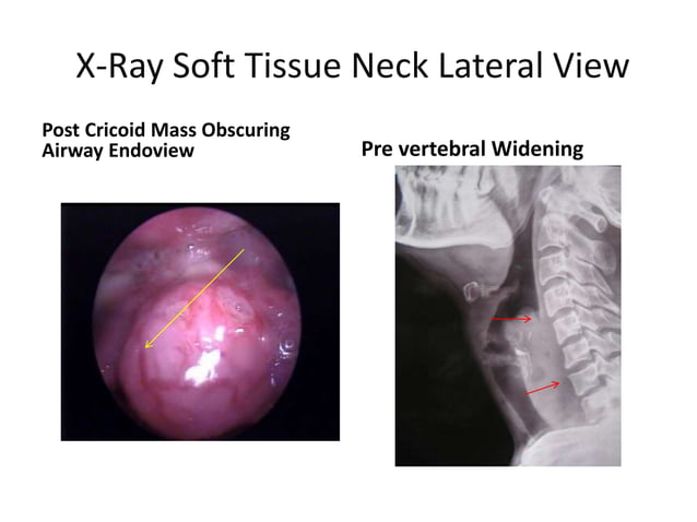X ray soft tissue neck valuable economic tool | PPT