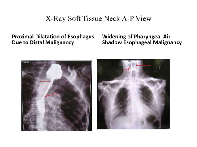 X ray soft tissue neck valuable economic tool | PPT