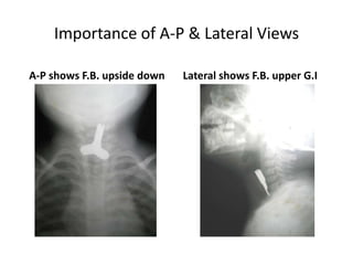 Laryngitis X Ray