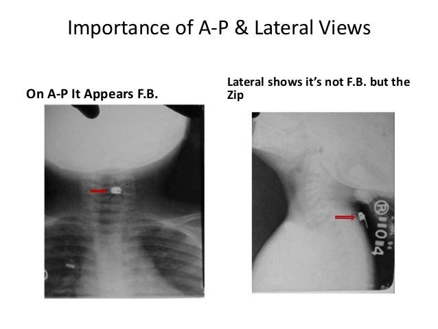 Xray Soft Tissue Neck Epomedicine