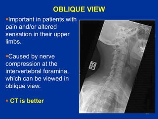 Oblique View Of Lumbar Spine