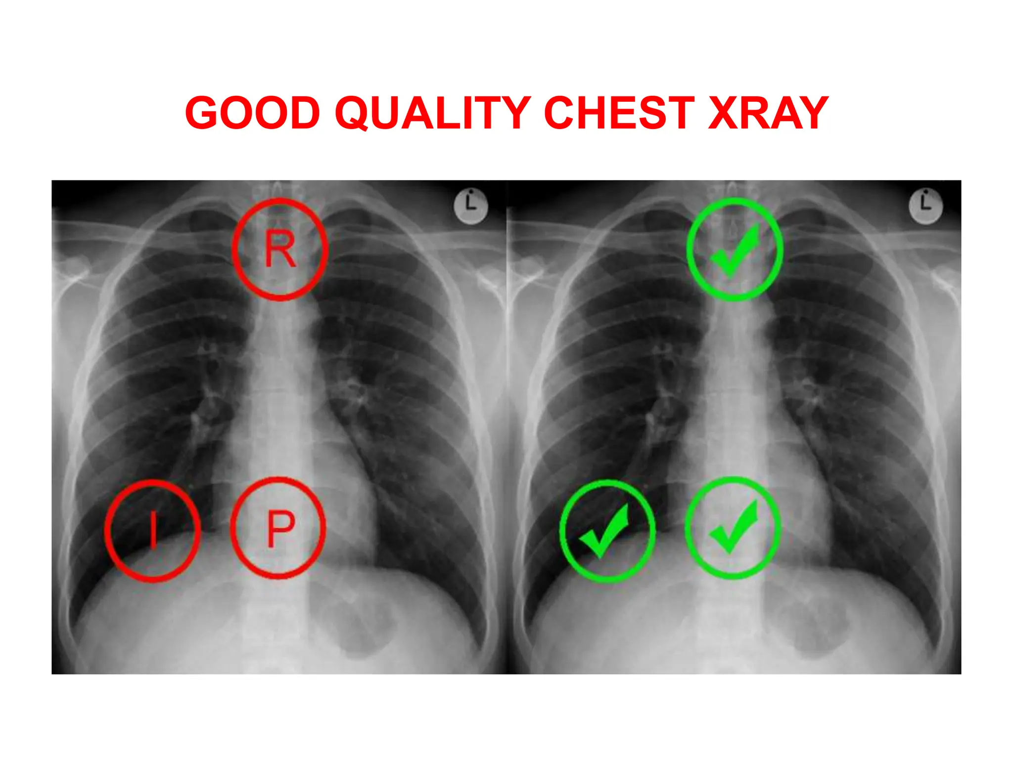 CHEST X-RAYS QUALITY,,,,,,,,,,,,,,,, pptx | PPTX