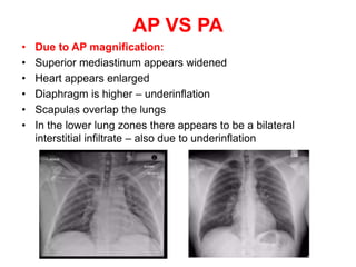 CHEST X-RAYS QUALITY,,,,,,,,,,,,,,,, pptx | PPT