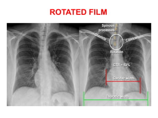 CHEST X-RAYS QUALITY,,,,,,,,,,,,,,,, pptx | PPTX