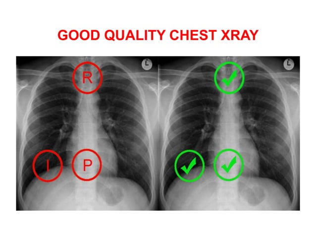 CHEST X-RAYS QUALITY,,,,,,,,,,,,,,,, pptx | PPTX | Lung and Respiratory ...