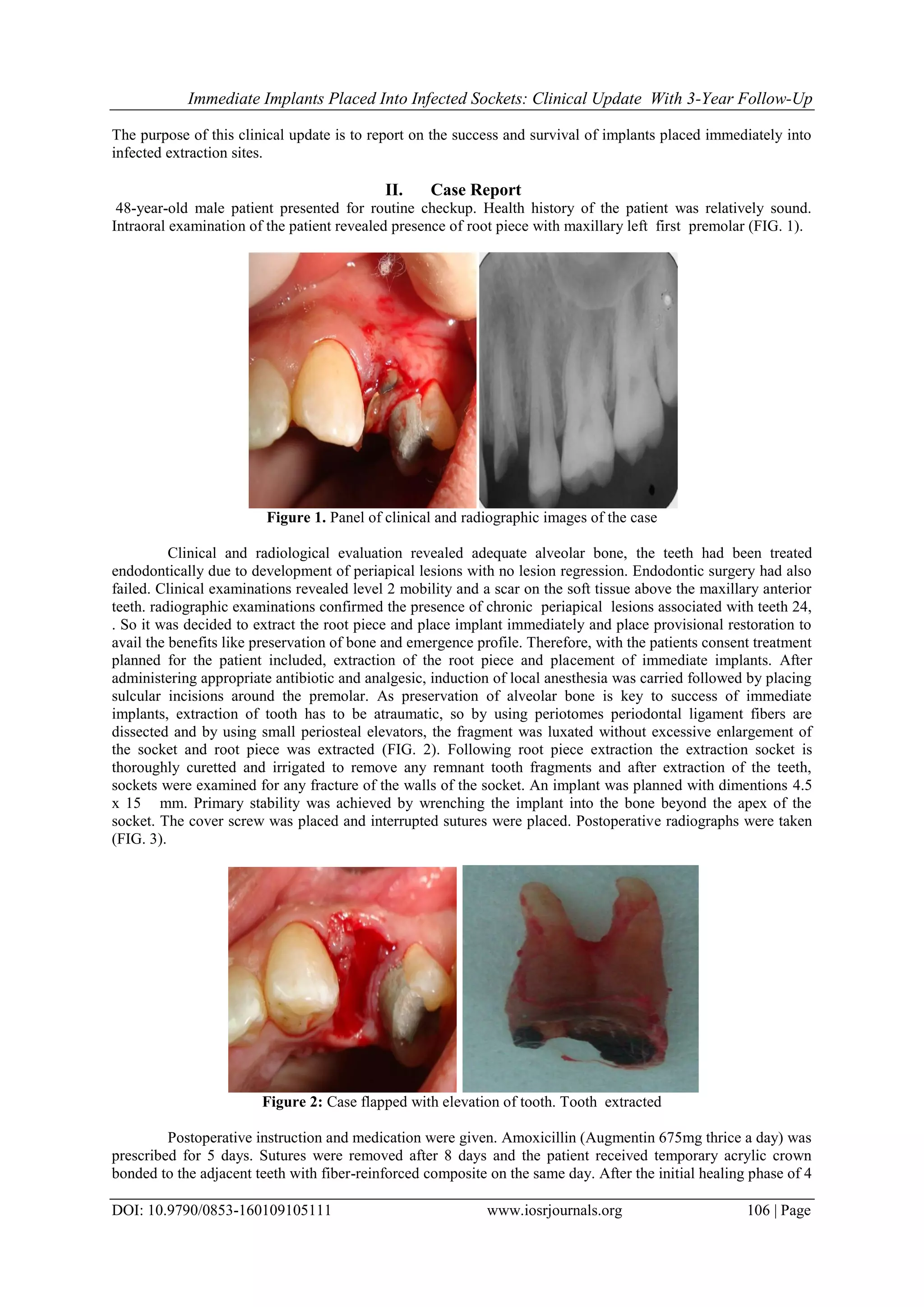 Immediate Implants Placed Into Infected Sockets: Clinical Update with 3-Year Follow-Up | PDF ...