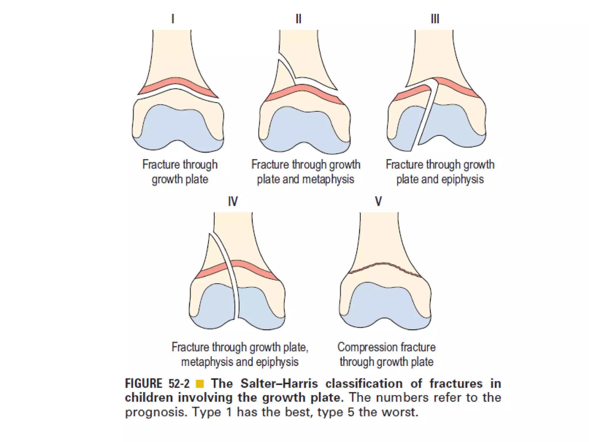 Skeletal trauma | PPT
