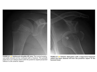 Skeletal trauma | PPT