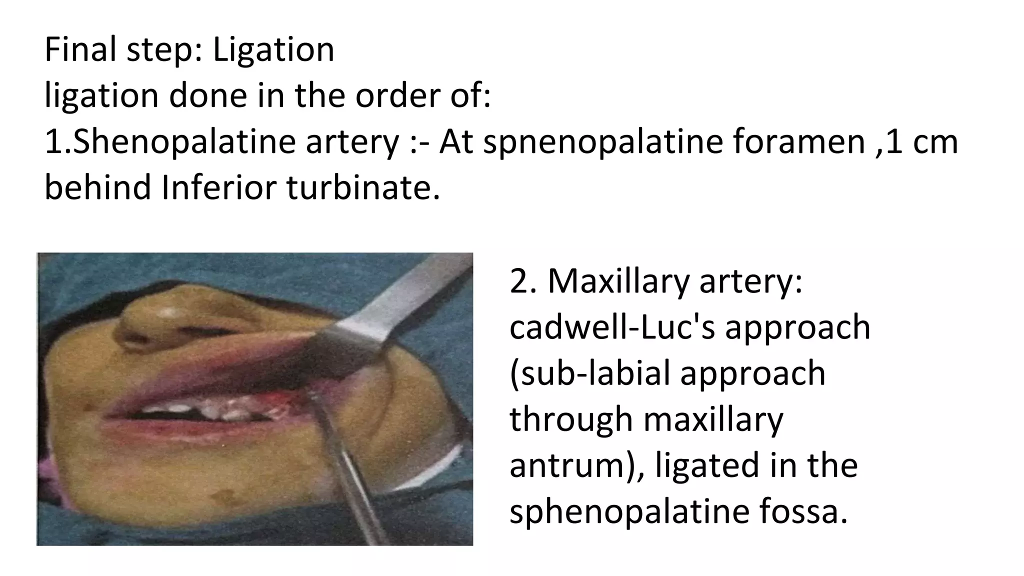 Epistaxis_Management.pptx