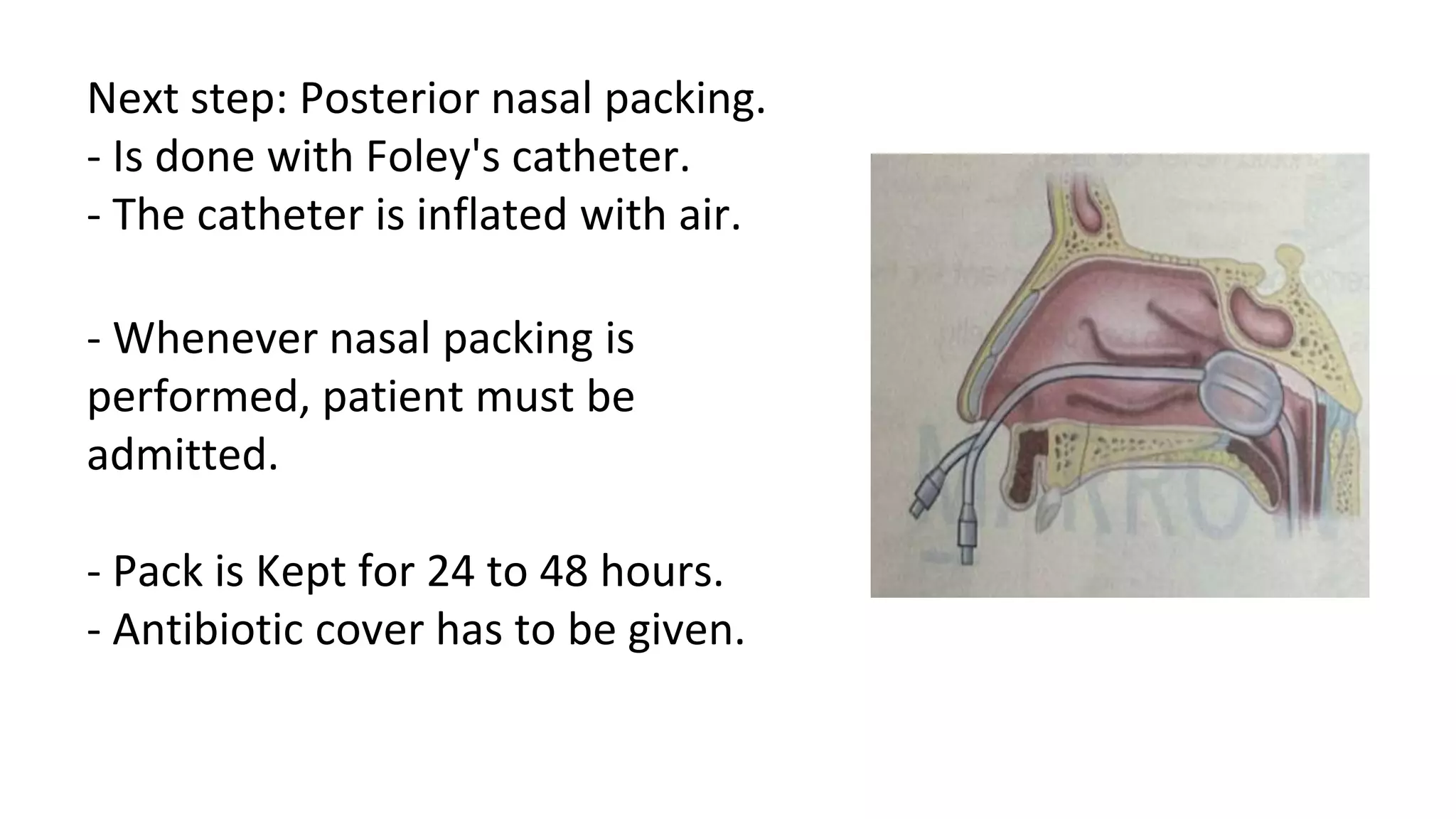 Epistaxis_Management.pptx