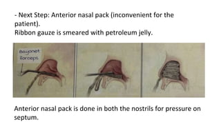 Epistaxis_Management.pptx
