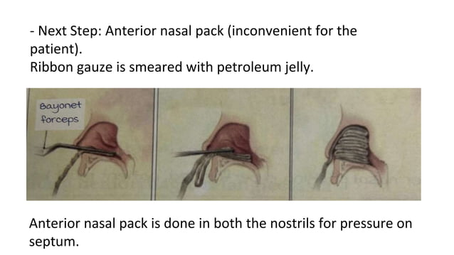 Epistaxis_Management.pptx