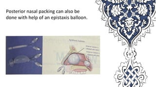 Epistaxis_Management.pptx