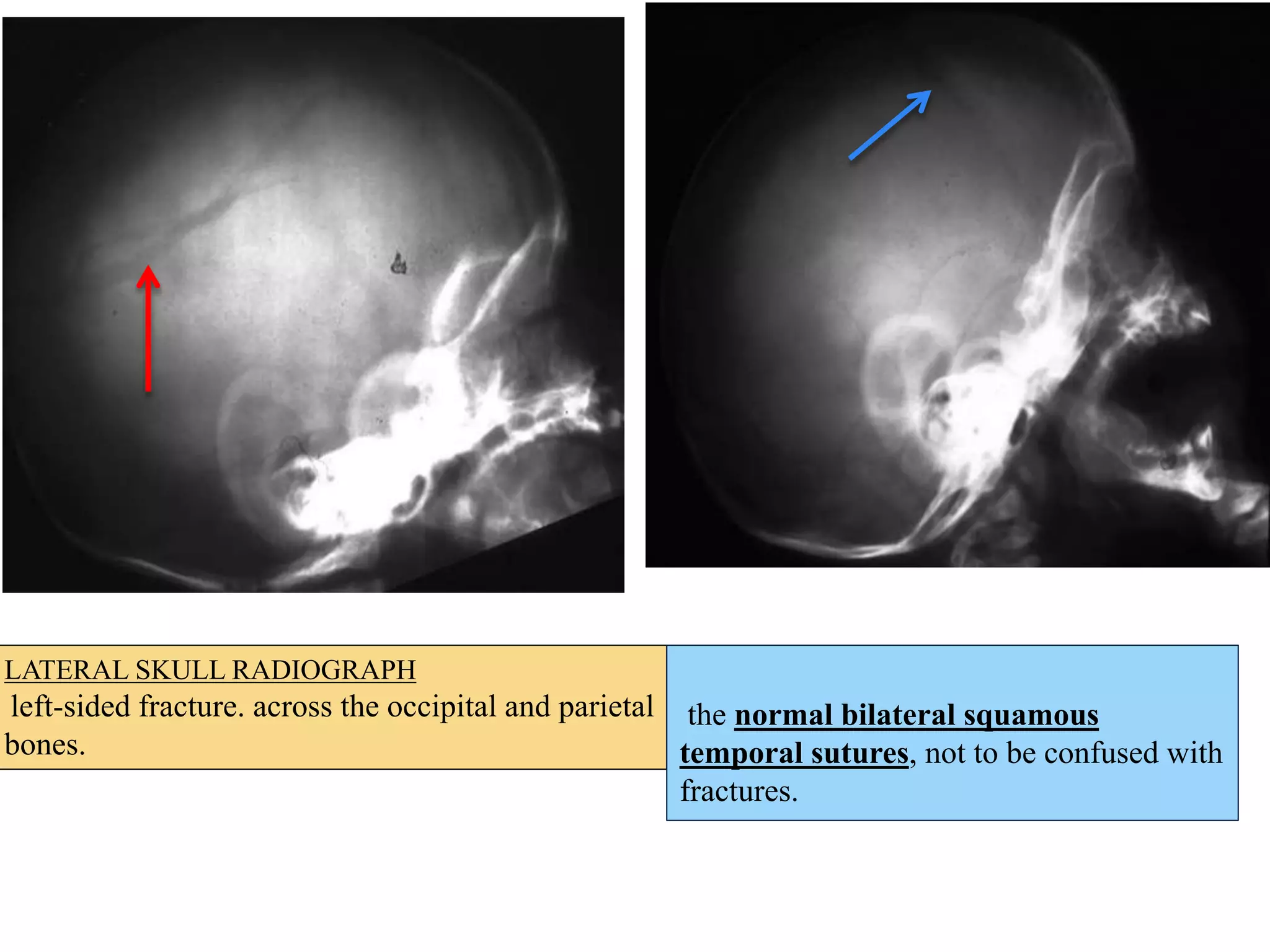 Anatomy of skull fractures | PPTX