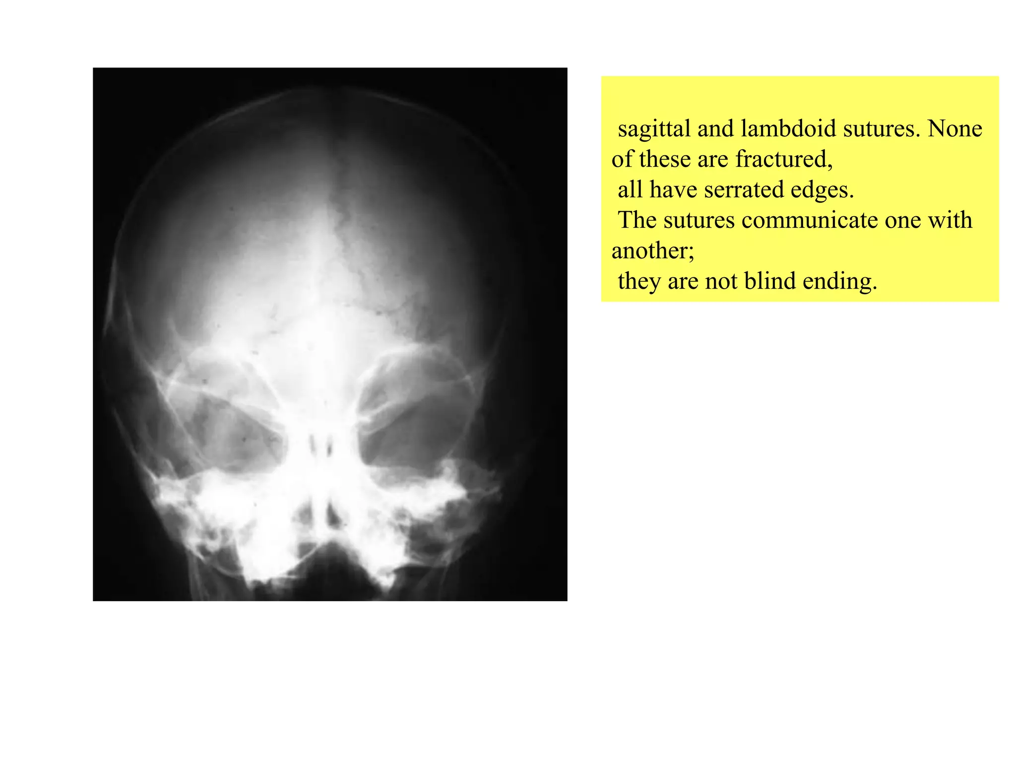 Anatomy of skull fractures | PPTX