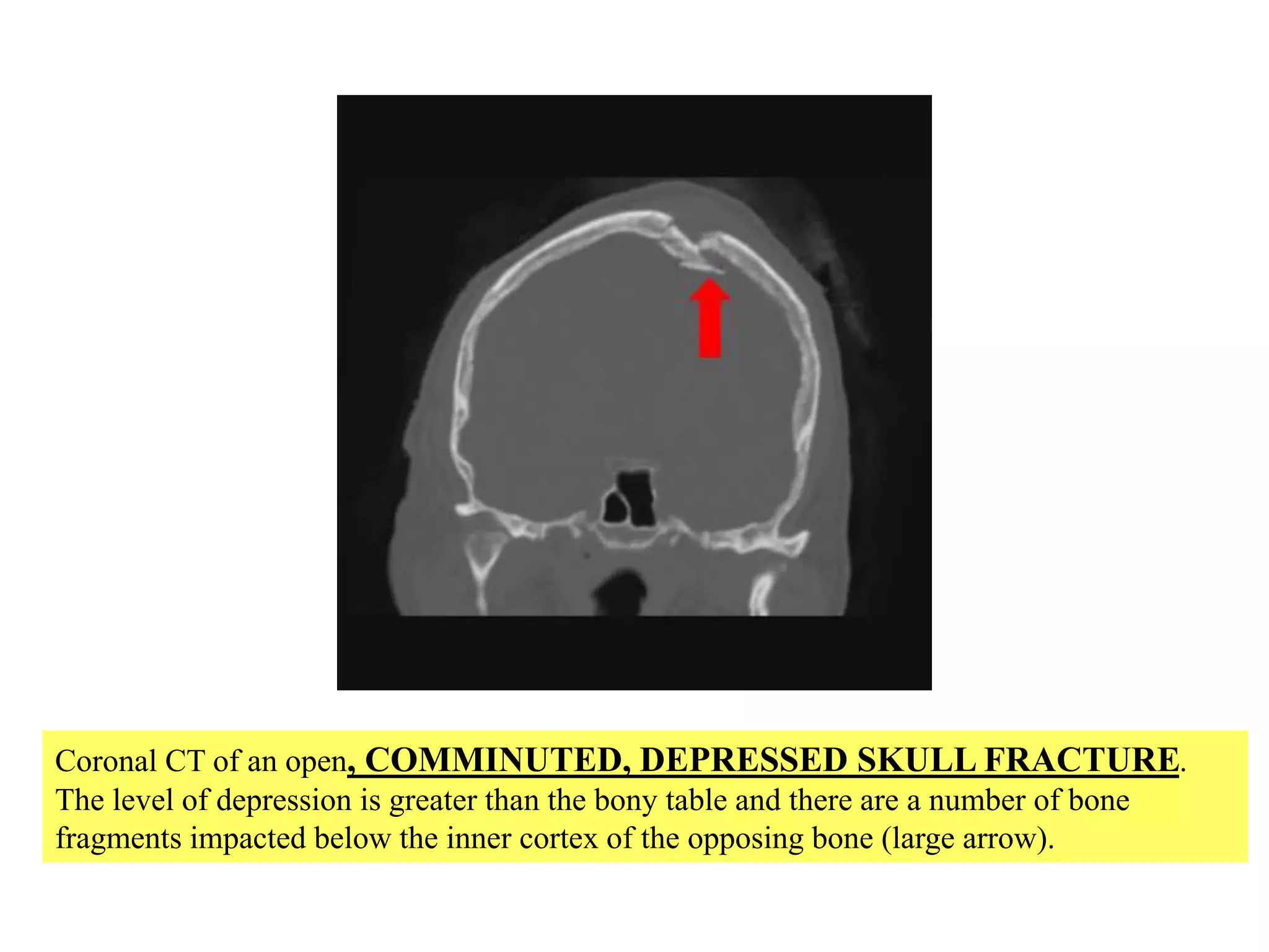 Anatomy of skull fractures | PPTX