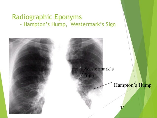 Xaheer shah...pulmonary embolism