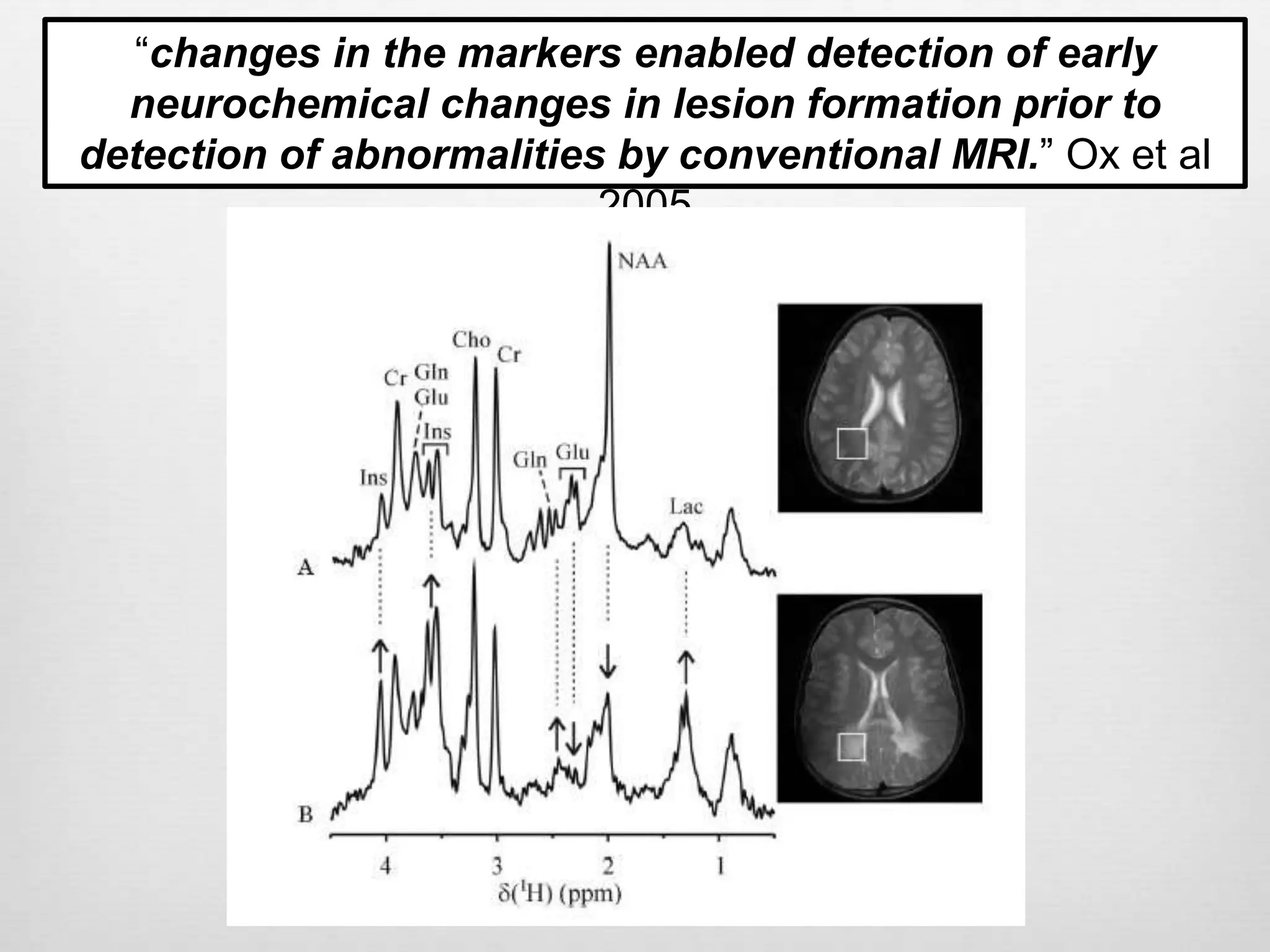 X-linked adrenoleukodystrophy: Radiological assessment | PPTX