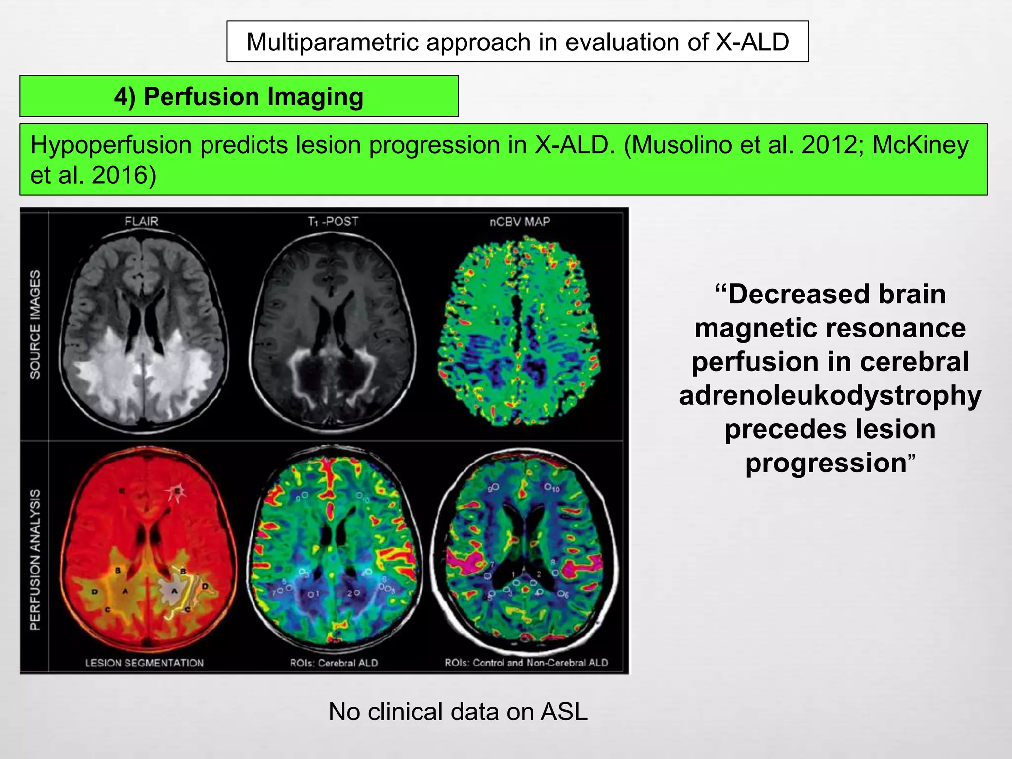 X-linked adrenoleukodystrophy: Radiological assessment | PPTX