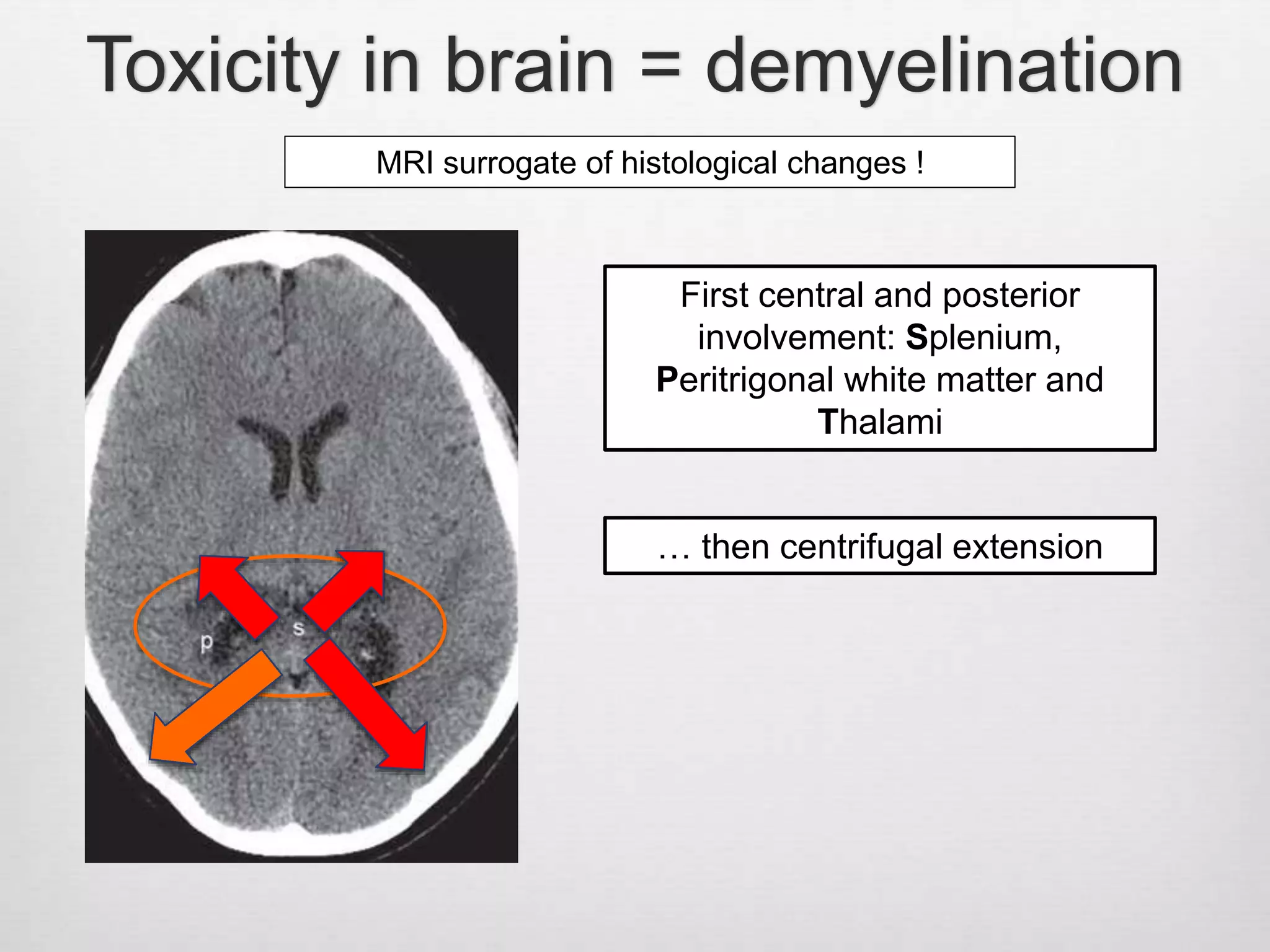 X-linked adrenoleukodystrophy: Radiological assessment | PPTX