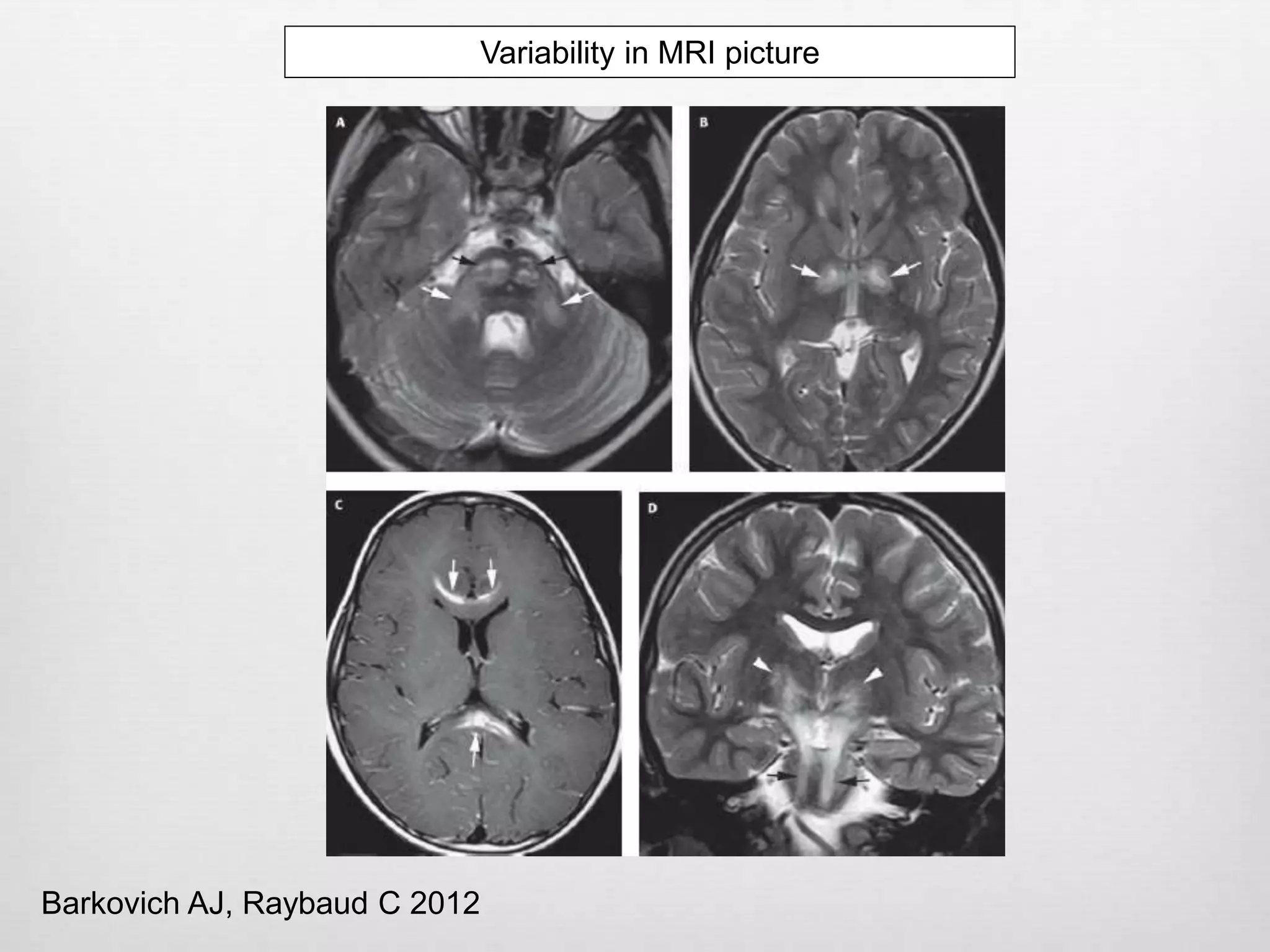 X-linked adrenoleukodystrophy: Radiological assessment | PPTX