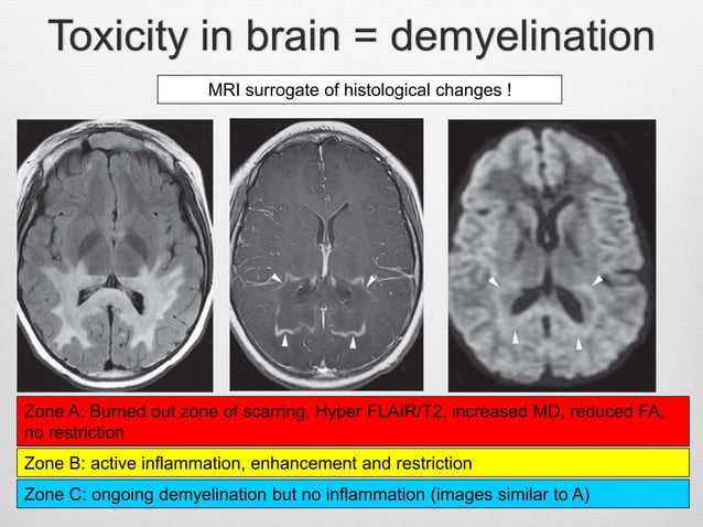X-linked adrenoleukodystrophy: Radiological assessment | PPTX