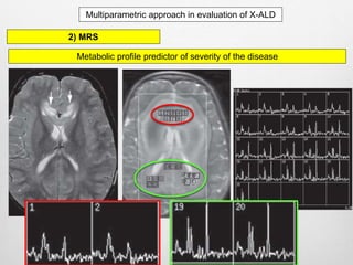 X-linked adrenoleukodystrophy: Radiological assessment | PPTX
