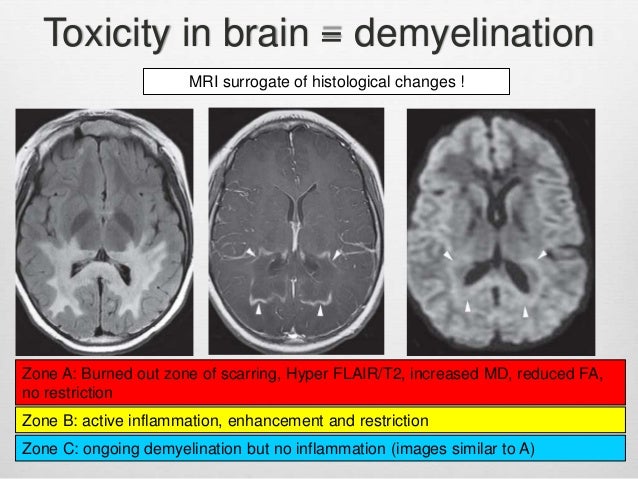 X-linked adrenoleukodystrophy: Radiological assessment