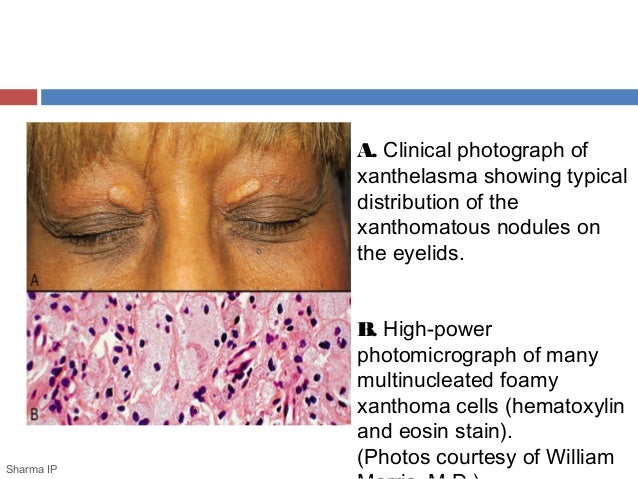 Xanthelasma Vs Xanthoma