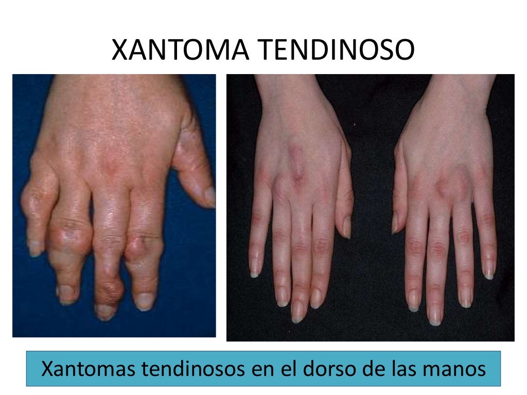 Xantomas