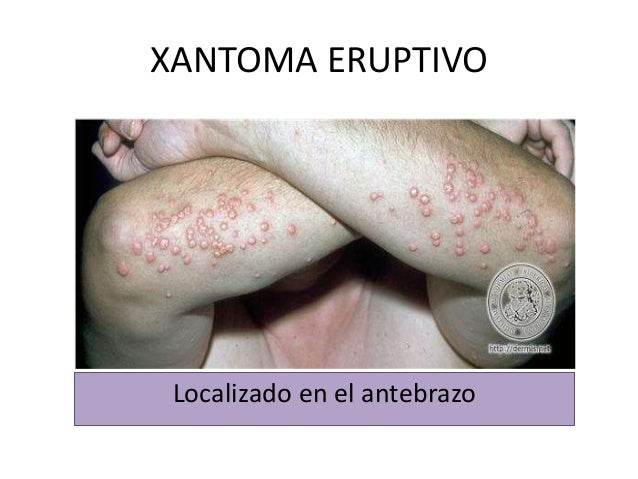 Histopatologia De Xantomas Eruptivos