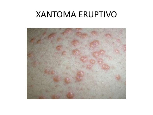Xantomatosis Eruptiva