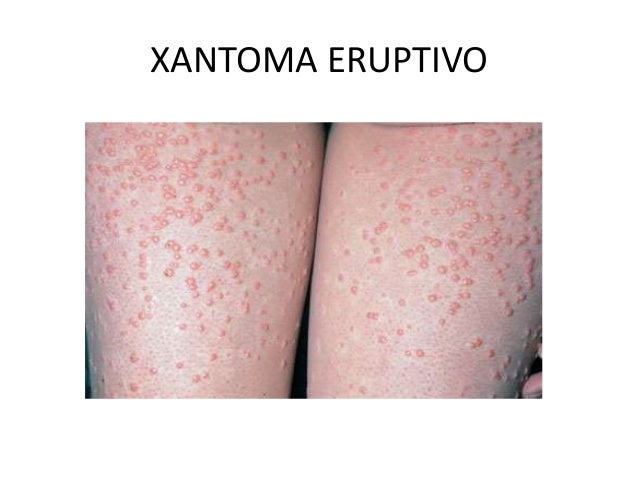 Xantomas