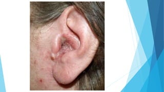 xarici otit.hg-1.pptx