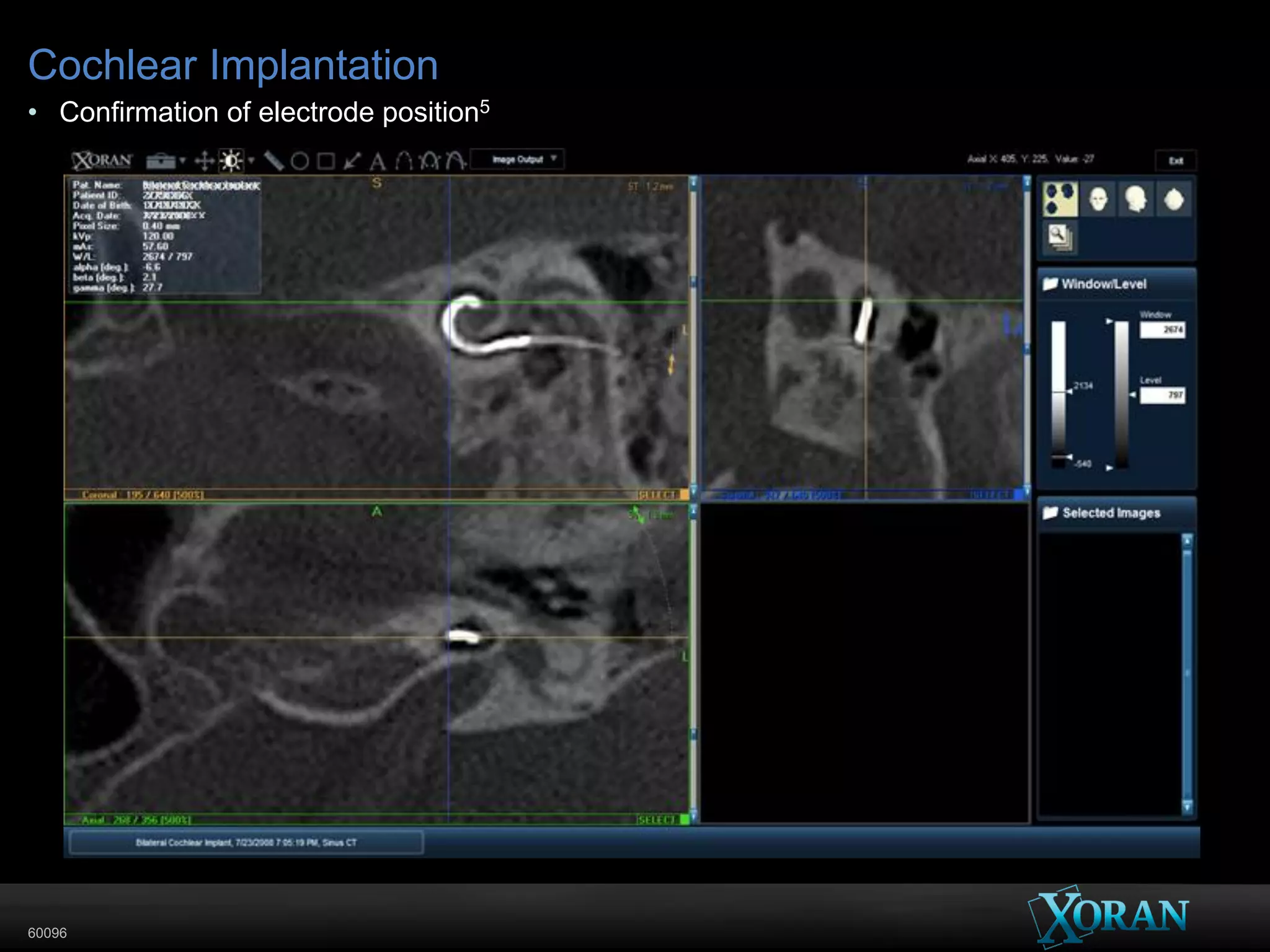 Xoran's xCAT - high resolution low dose head CT | PDF