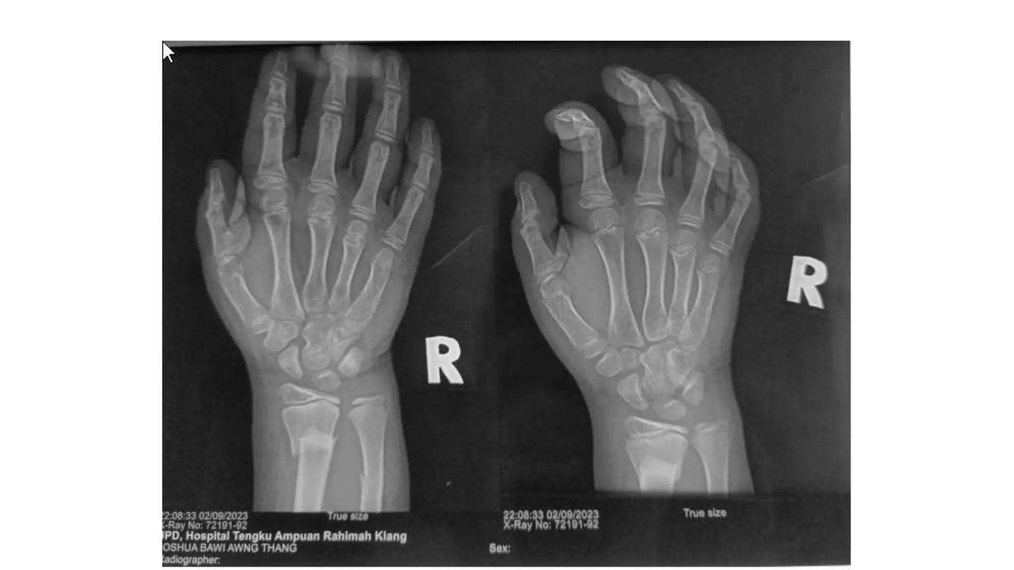 XCON 4b peri) FINAL.pptx xray images of htar patients to be uploaded | PPT