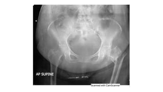 XCON 4b peri) FINAL.pptx xray images of htar patients to be uploaded | PPT