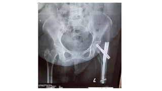 XCON 4b peri) FINAL.pptx xray images of htar patients to be uploaded | PPT