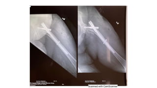 XCON 4b peri) FINAL.pptx xray images of htar patients to be uploaded | PPT