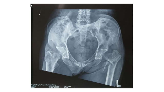 XCON 4b peri) FINAL.pptx xray images of htar patients to be uploaded | PPT