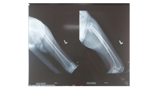 XCON 4b peri) FINAL.pptx xray images of htar patients to be uploaded | PPT