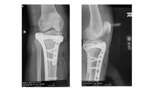 XCON 4b peri) FINAL.pptx xray images of htar patients to be uploaded | PPT