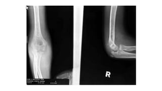 XCON 4b peri) FINAL.pptx xray images of htar patients to be uploaded | PPT