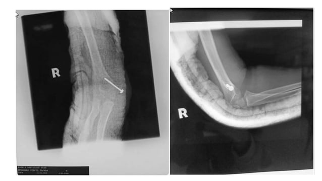 XCON 4b peri) FINAL.pptx xray images of htar patients to be uploaded | PPT