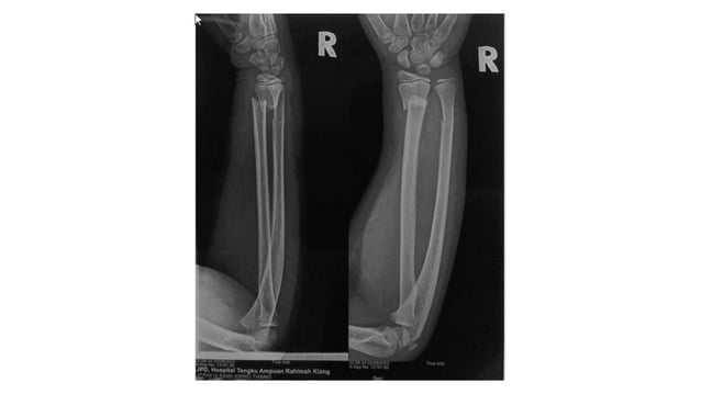 XCON 4b peri) FINAL.pptx xray images of htar patients to be uploaded | PPT