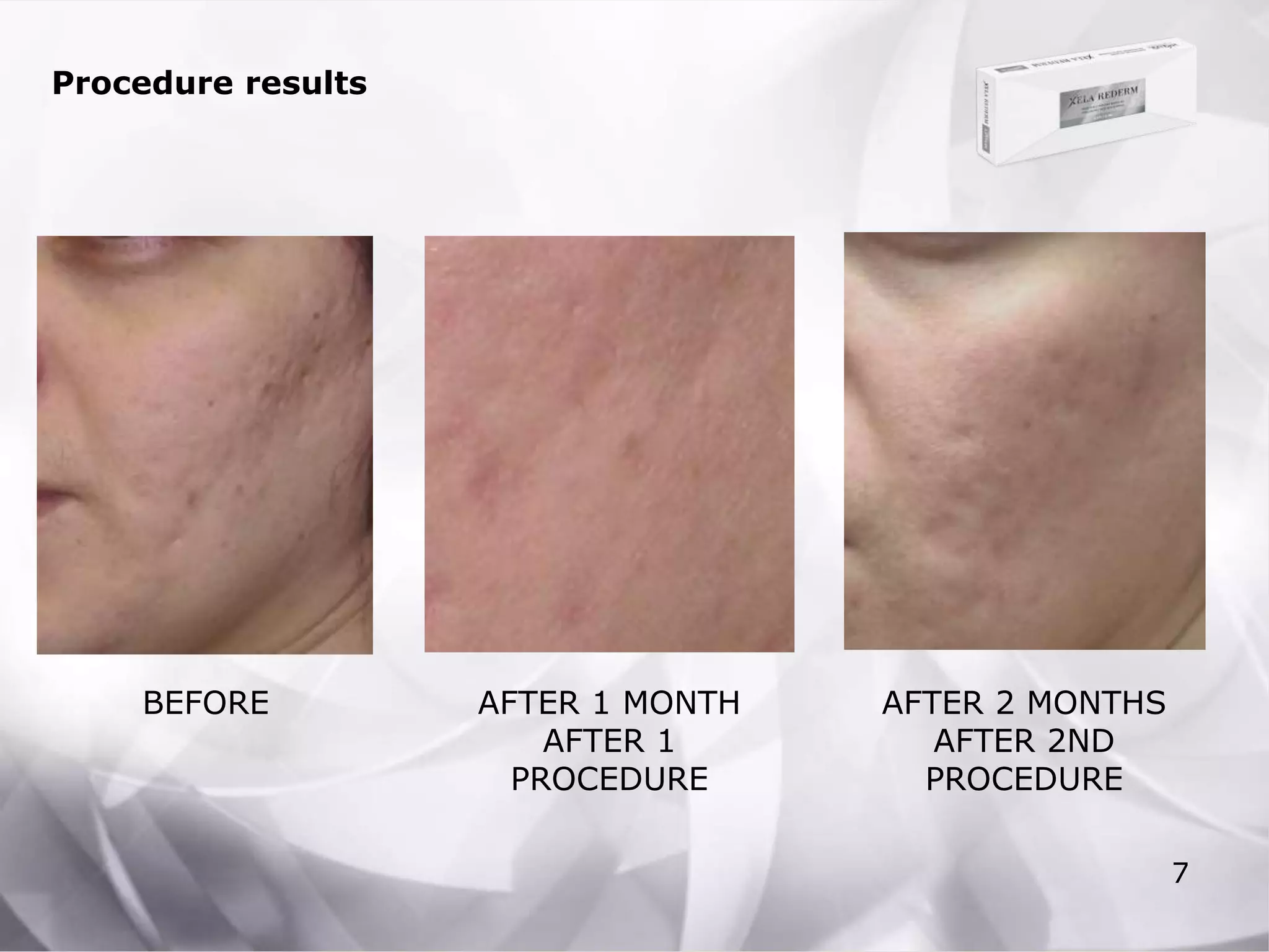 Xela rederm before after results | PPTX