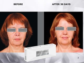 Xela rederm before after results | PPTX