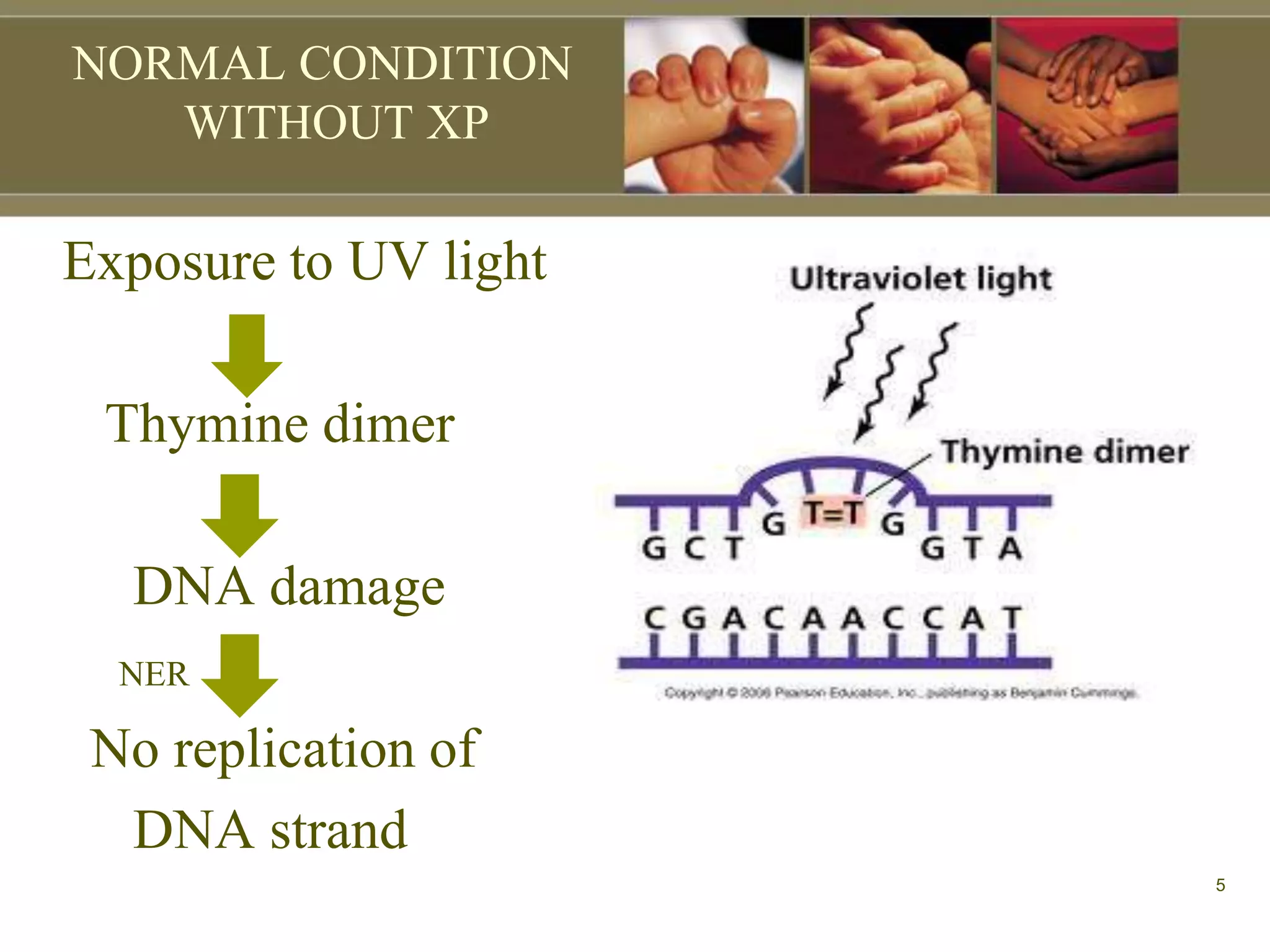 Xeroderma Pigmentosum | PPTX