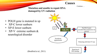 Xeroderma pigmentosum | PPT