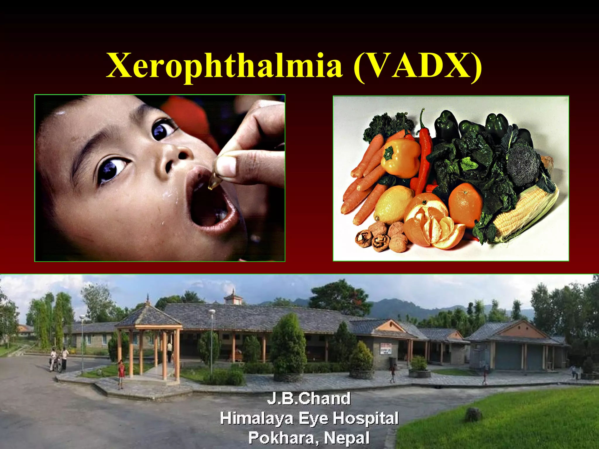 Xerophthalmia | PPT